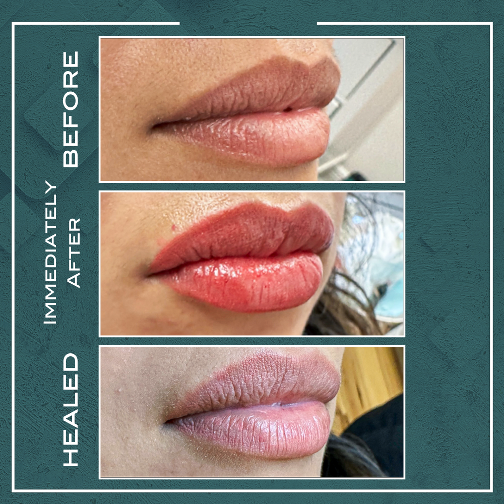 Dark Lip Neutralization London